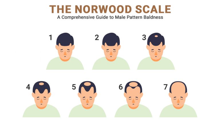 Measure your hair loss with Norwood Scale - InnoSurgicalCare
