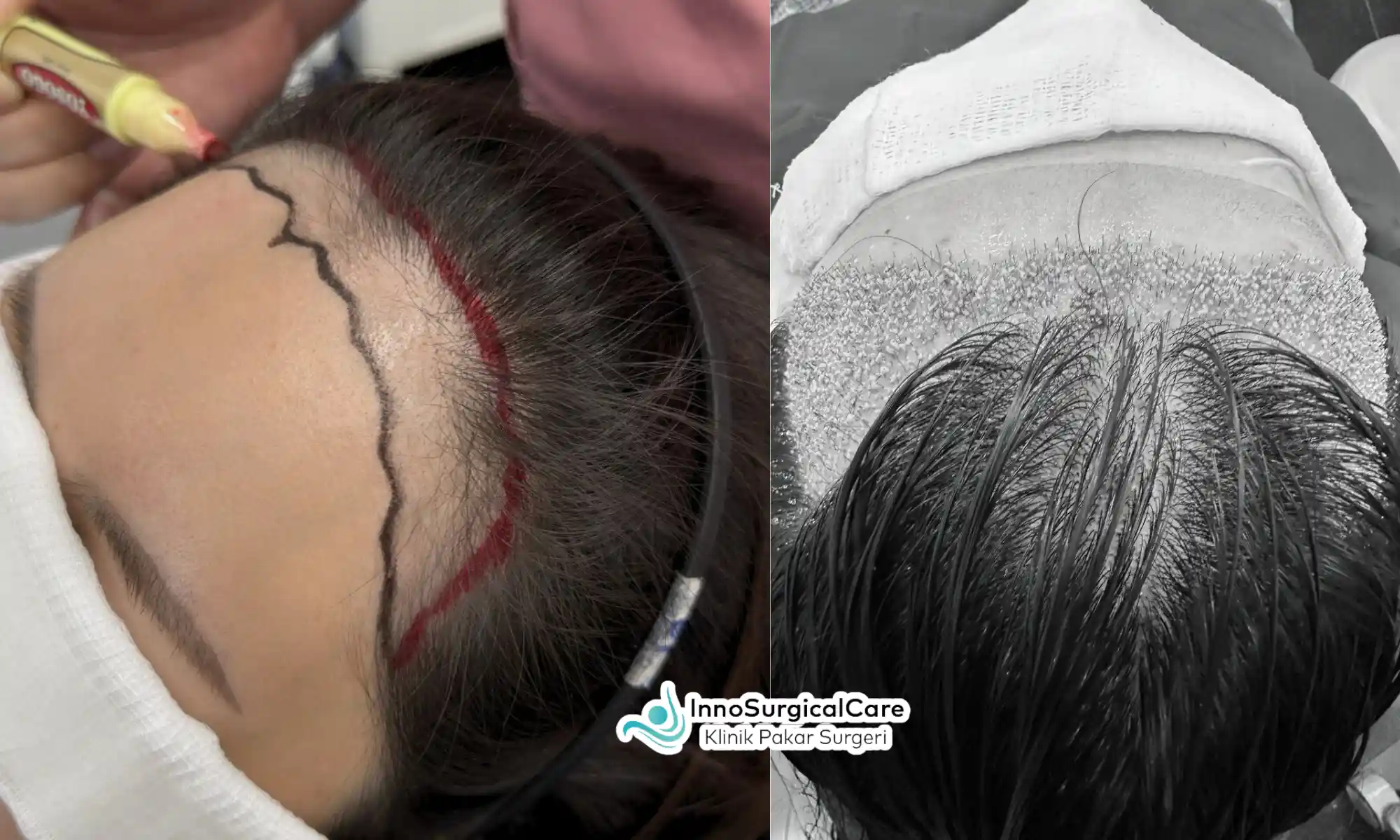 Female Hair Transplant - InnoSurgicalCare